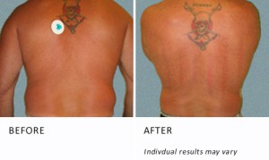 Abs/Flanks - KleinLipo - Liposuction Surgery of Orange County